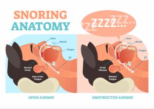 Sleep Apnoea & Snoring Treatment in Singapore | Aglow ENT Centre