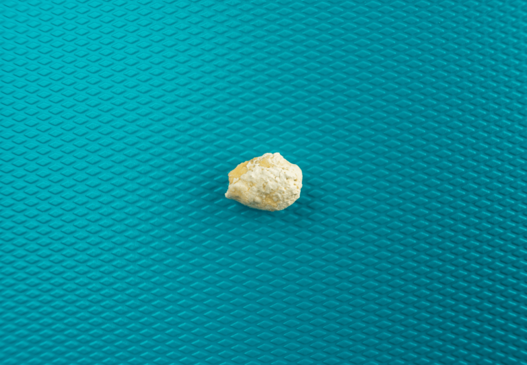 Salivary Gland & Duct Stones | Aglow ENT Centre