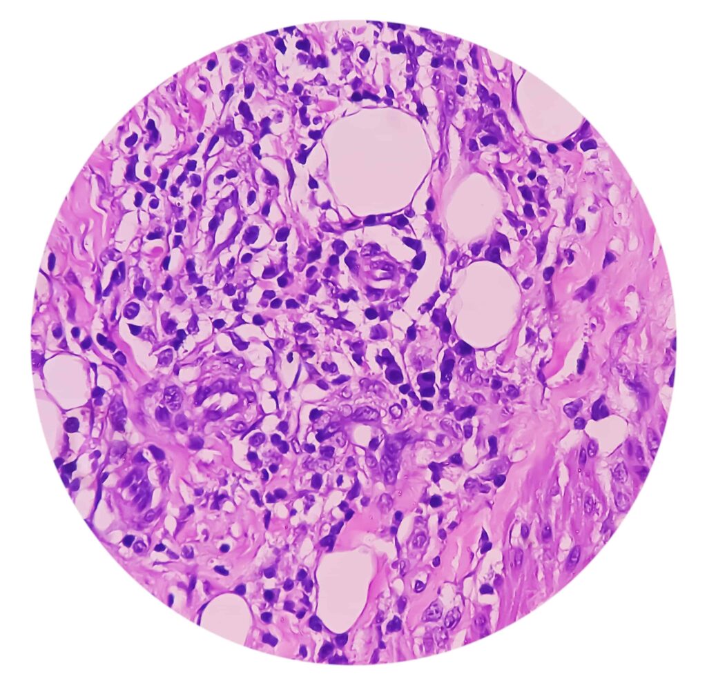 Excision Biopsy Of Lymph Node Aglow Ent Centre 6074