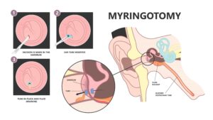 Myringotomy & Grommet Tube Insertion | Aglow ENT Centre