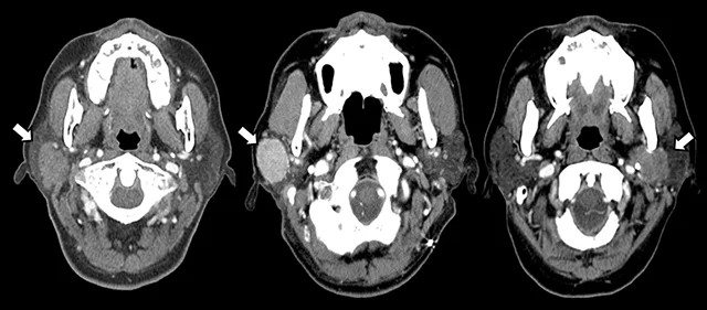 A Patient’s Guide to Parotid Gland Tumour Surgery in Singapore